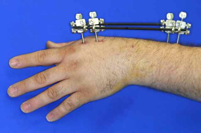 Wrist Fractures (or fractures of the distal radius)